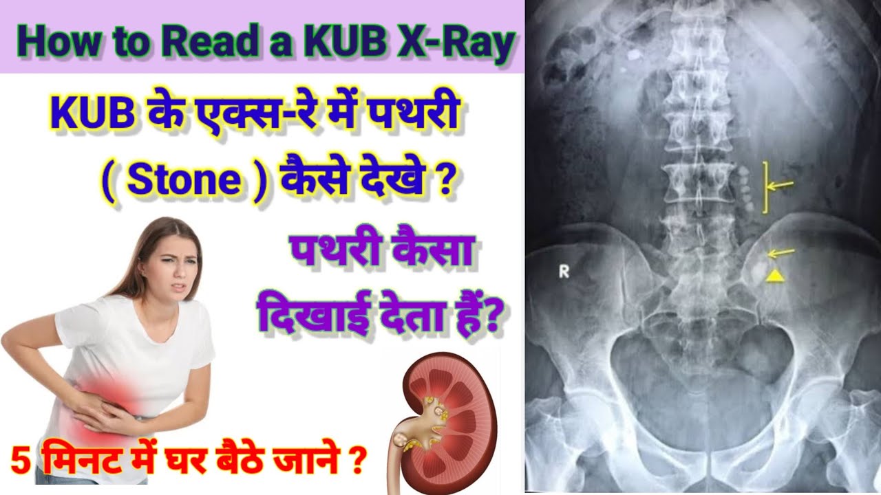 KUB How To Read KUB X Ray 