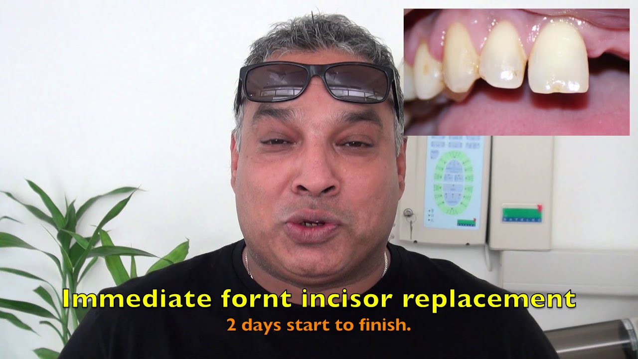 implant and ceramic porcelain crown india punjab jalandhar suresh basra ...