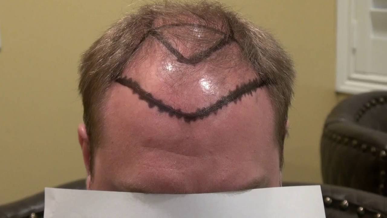 California Hair Transplant Restoration Advanced Hair Loss Pattern Dr ...