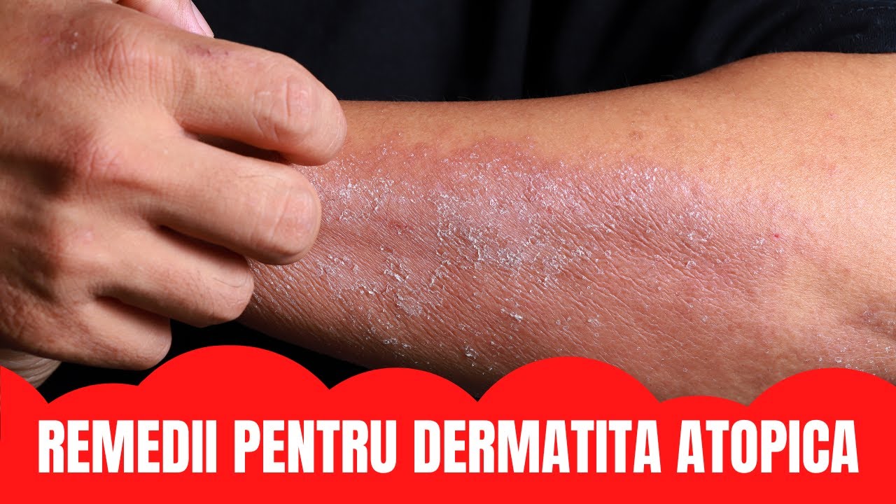 DERMATITA ATOPICA - YouTube