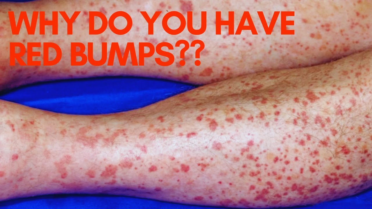 Red Bumps on Your Skin? Here’s How to Diagnose Them! #insectbites # ...