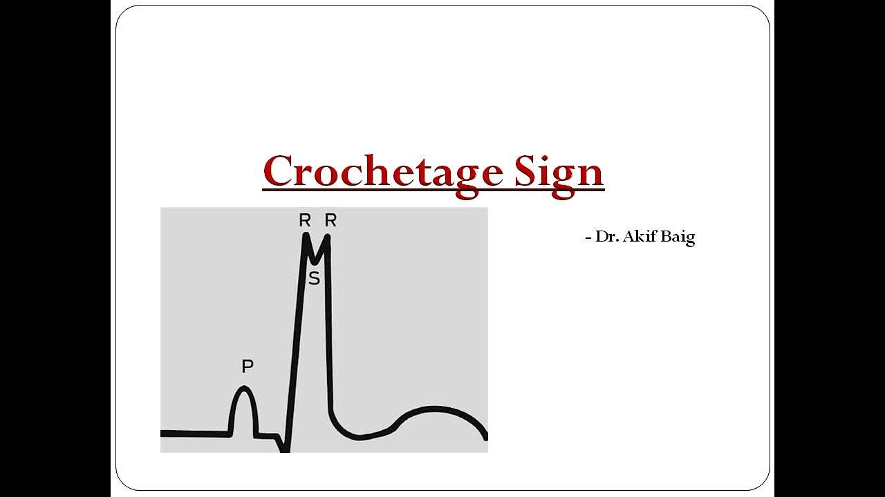 Crochetage sign in ASD : Dr. Akif Baig - YouTube