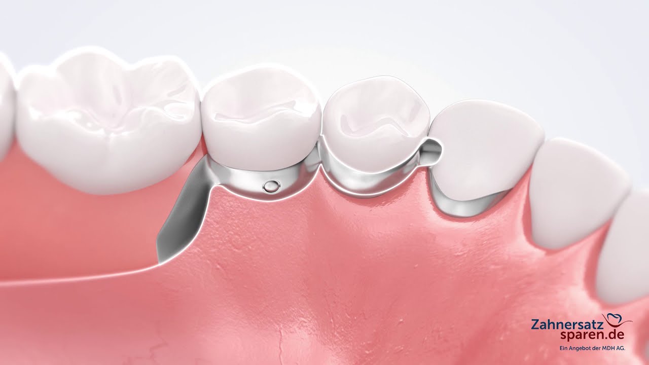 Behandlungsablauf: Riegelprothese - Zahnersatzsparen.de - YouTube