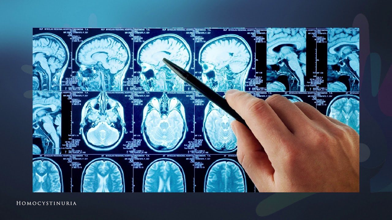 28 - Homocystinuria - YouTube