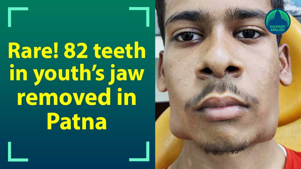 Doctors removed 82 rare teeth from 17-yr-old boy’s jaw; 1st in the ...