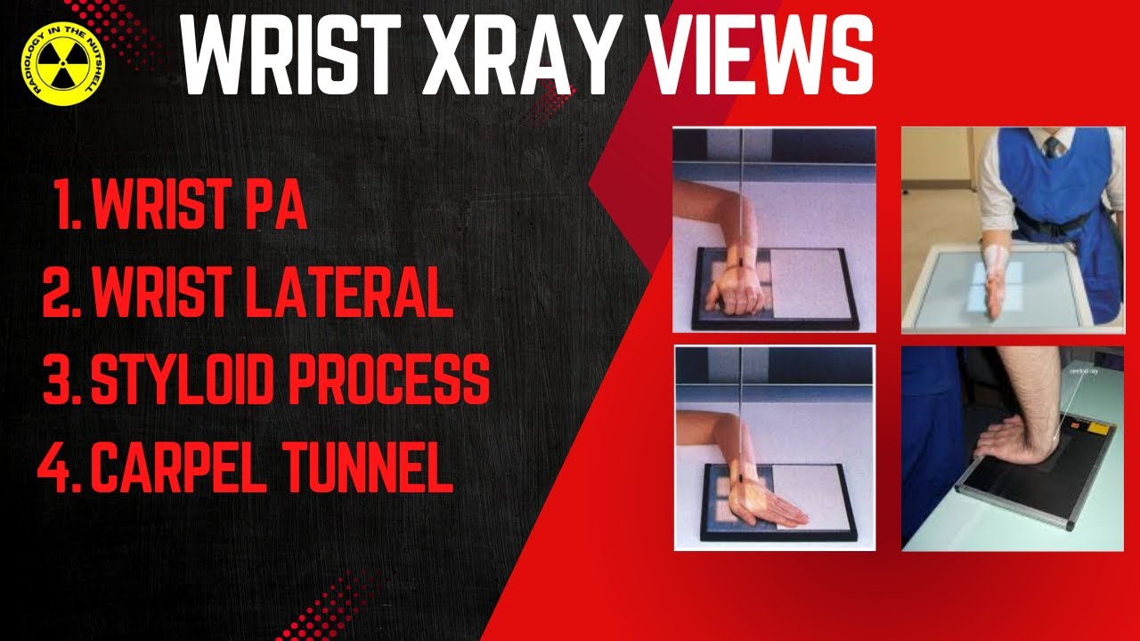 WRIST XRAY || WRIST PA ,LATERAL || STYLOID PROCESS || CARPEL TUNNEL ...