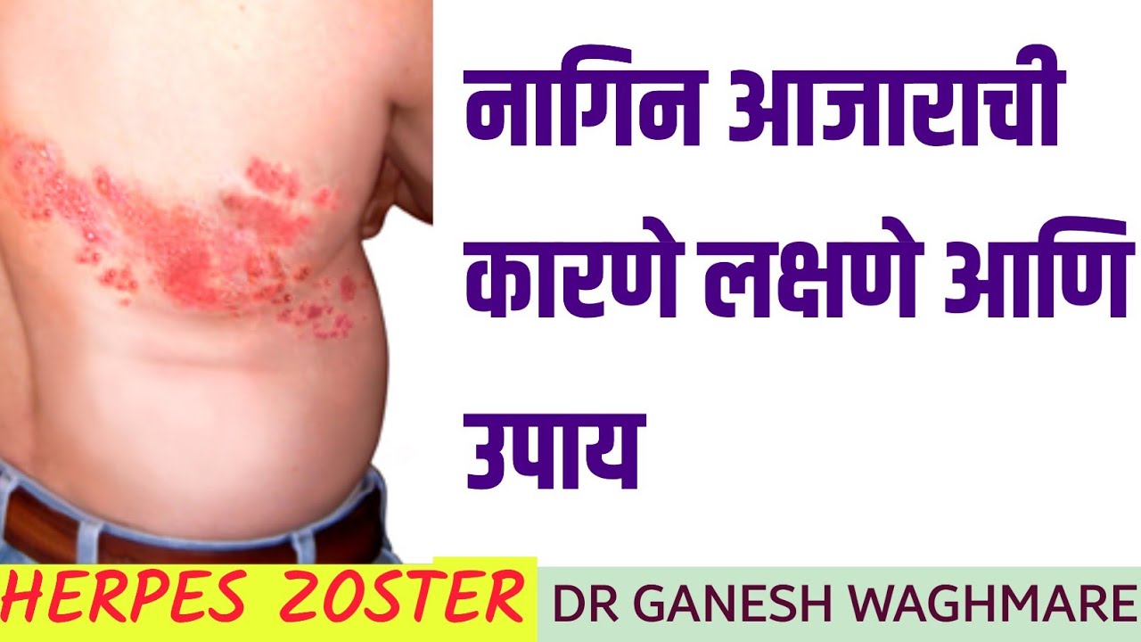 नागीण आजाराची कारणे, लक्षणे आणि उपचार | नागीन गैरसमज आणि उपाय | Herpes ...