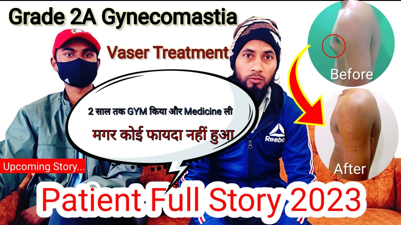 Gynecomastia Grade 2 Patient Full Story 2023 | Grade 2a Gynecomastia ...
