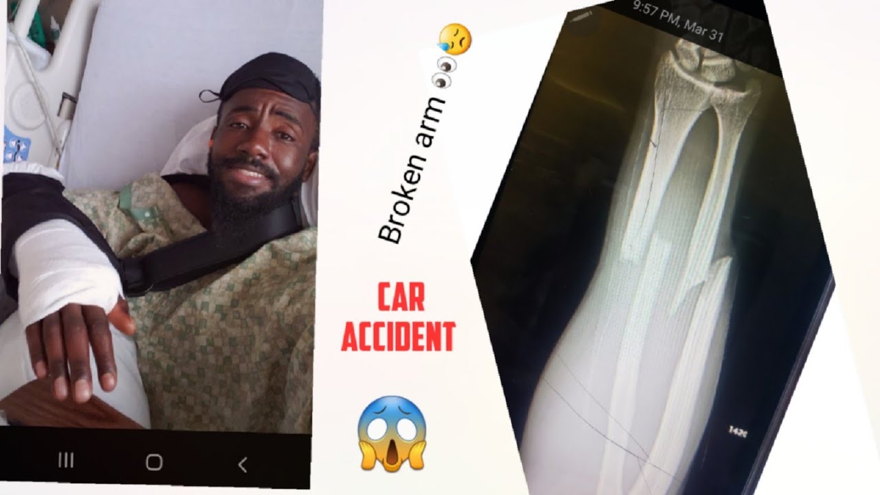 First time In a Car Accident/ Broken Arm (Storytime) - YouTube