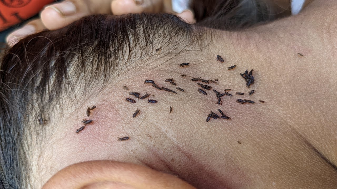 How to get out all of head lice - Pick out a hundred lice from hair ...