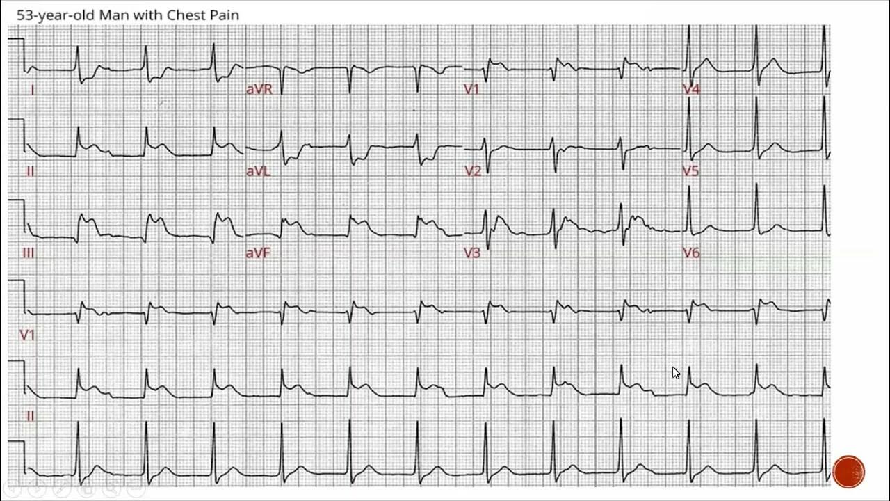 ECG coding for the board, Dr Saleh Albasiri, 14/8/2021 - YouTube