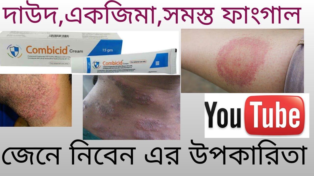 Combicid cream এর সম্পর্কে বিস্তারিত জানুন।দাউদ,একজিমা,চর্মরোগের ওষুধ ...