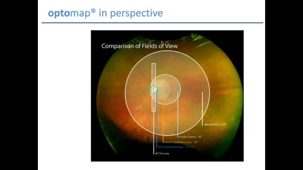 Important Findings in the Retinal Periphery: The Case for Ultra ...