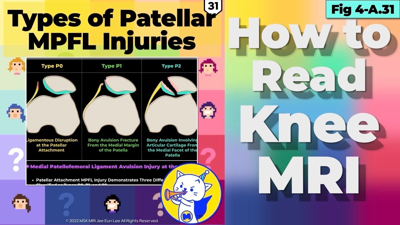 (Fig 4-A.31) Three Types of Patellar MPFL Injuries at the Patella - YouTube