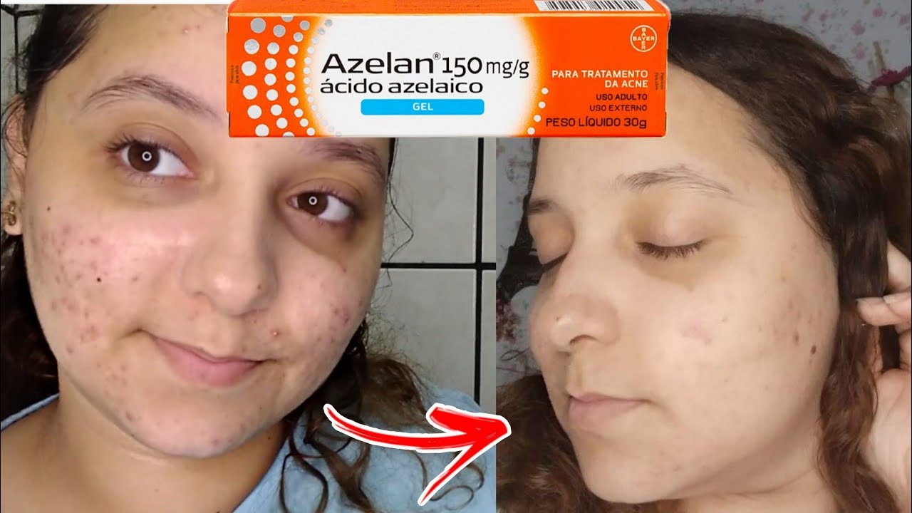 funciona mesmo? minha experiência usando o gel azelan ácido azeláico ...