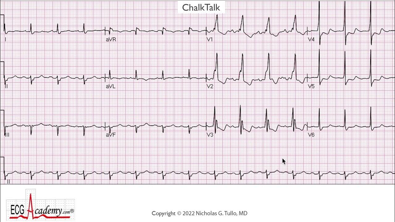 12-Lead ECG Challenge - Learn to Read EKG with Dr. Nick - YouTube