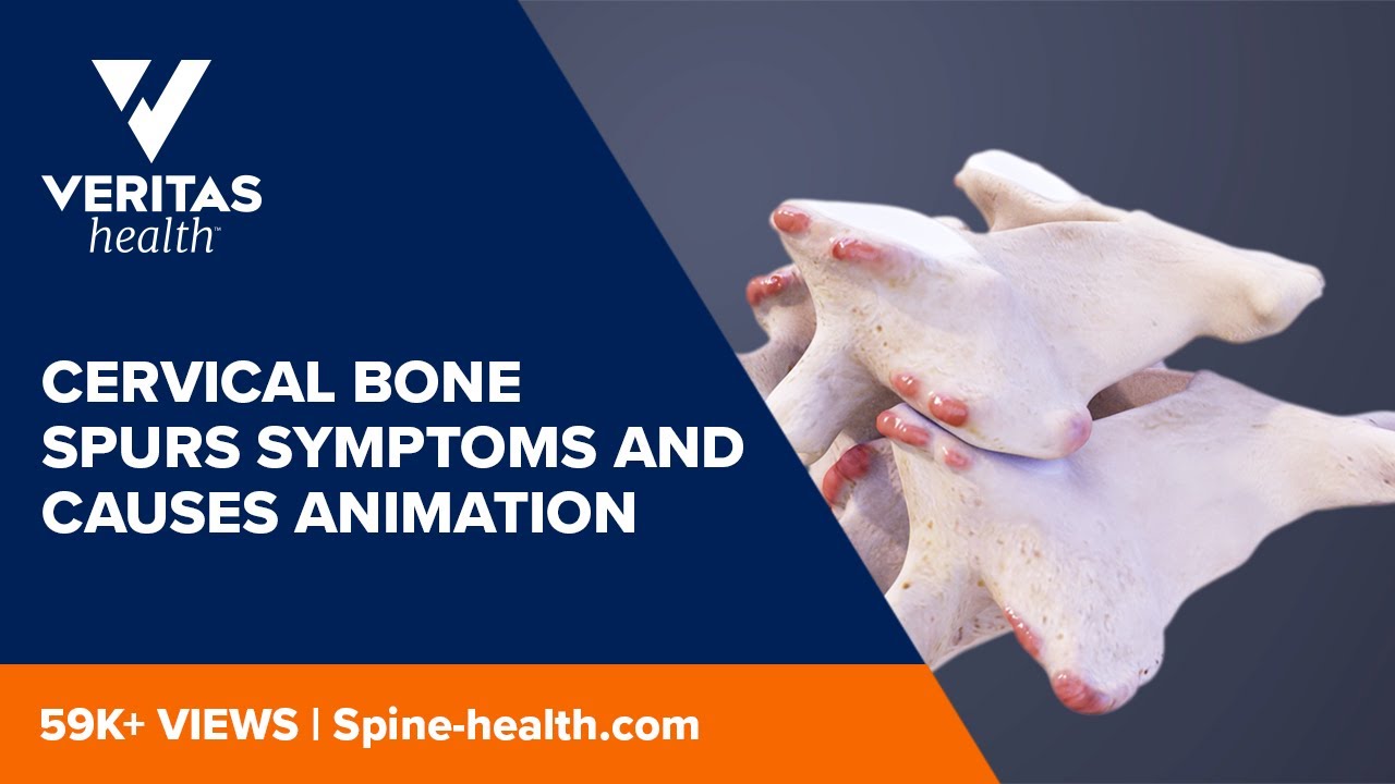 Cervical Bone Spurs Symptoms and Causes Animation - YouTube
