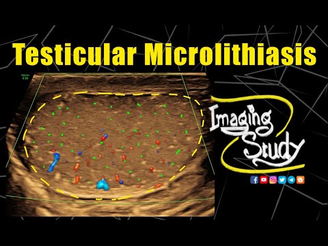 Testicular Microlithiasis || Ultrasound || Case 334