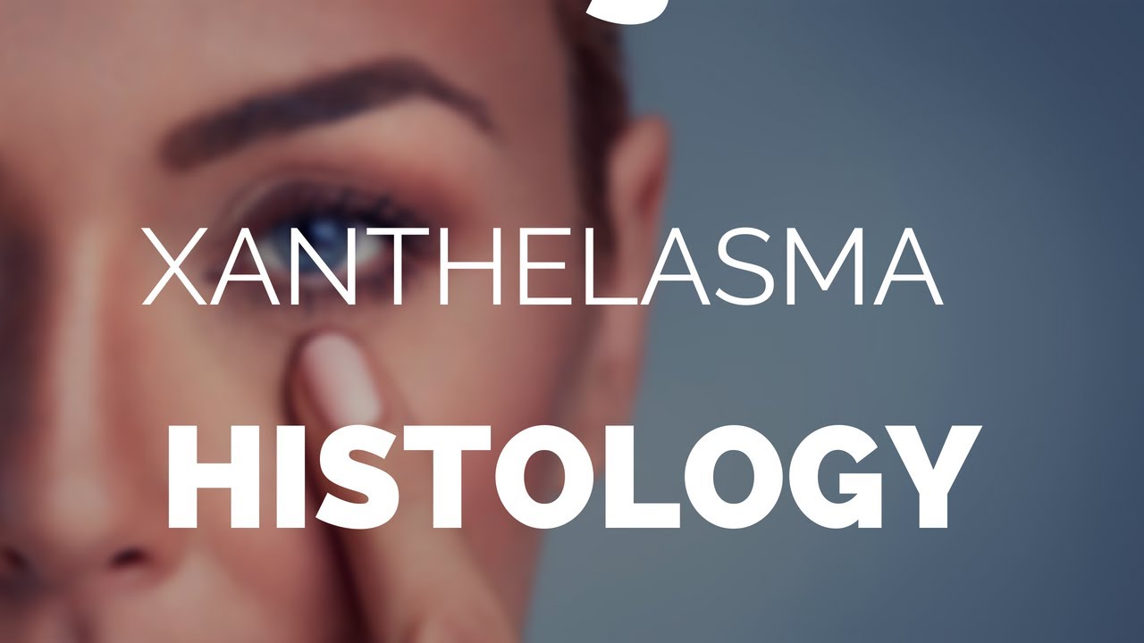 Xanthelasma histology, under the microscope with Xanthelasma. - YouTube