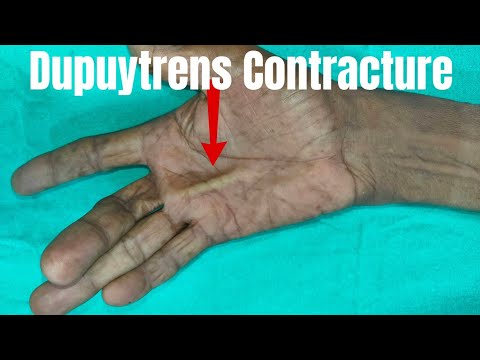 Dupuytrens Contracture of hand - Change after surgery| Hand surgery in ...