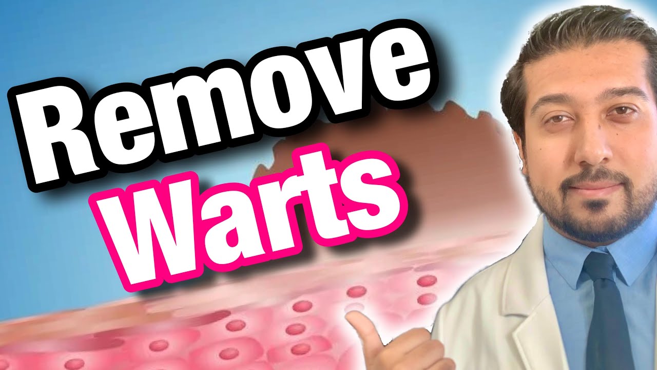 Wart Removal 101 | How to Get Rid of Warts - YouTube