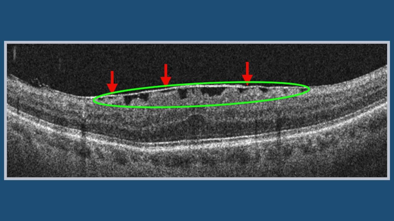 Epiretinal Membrane (ERM) - YouTube