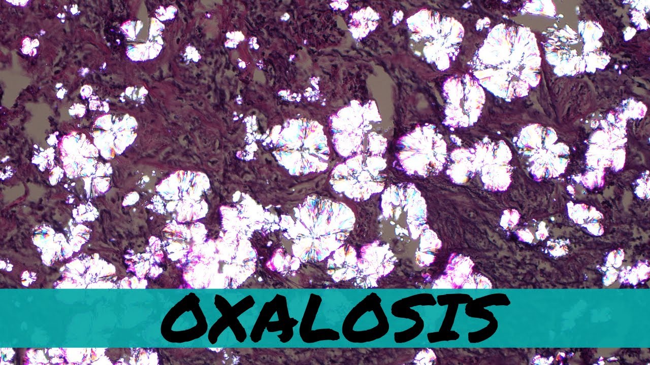 Oxalate (Oxalic Acid) Crystals Under the Microscope (cutaneous oxalosis ...