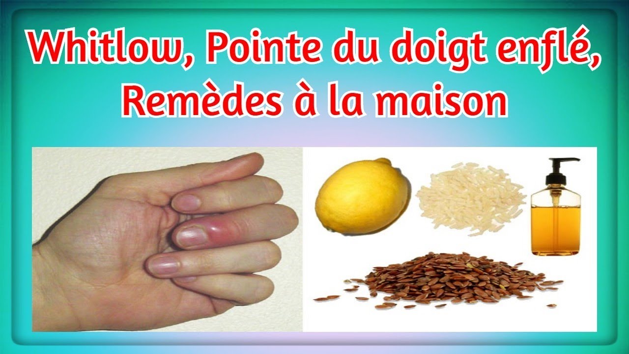Whitlow, Pointe du doigt enflé, Remèdes à la maison - YouTube