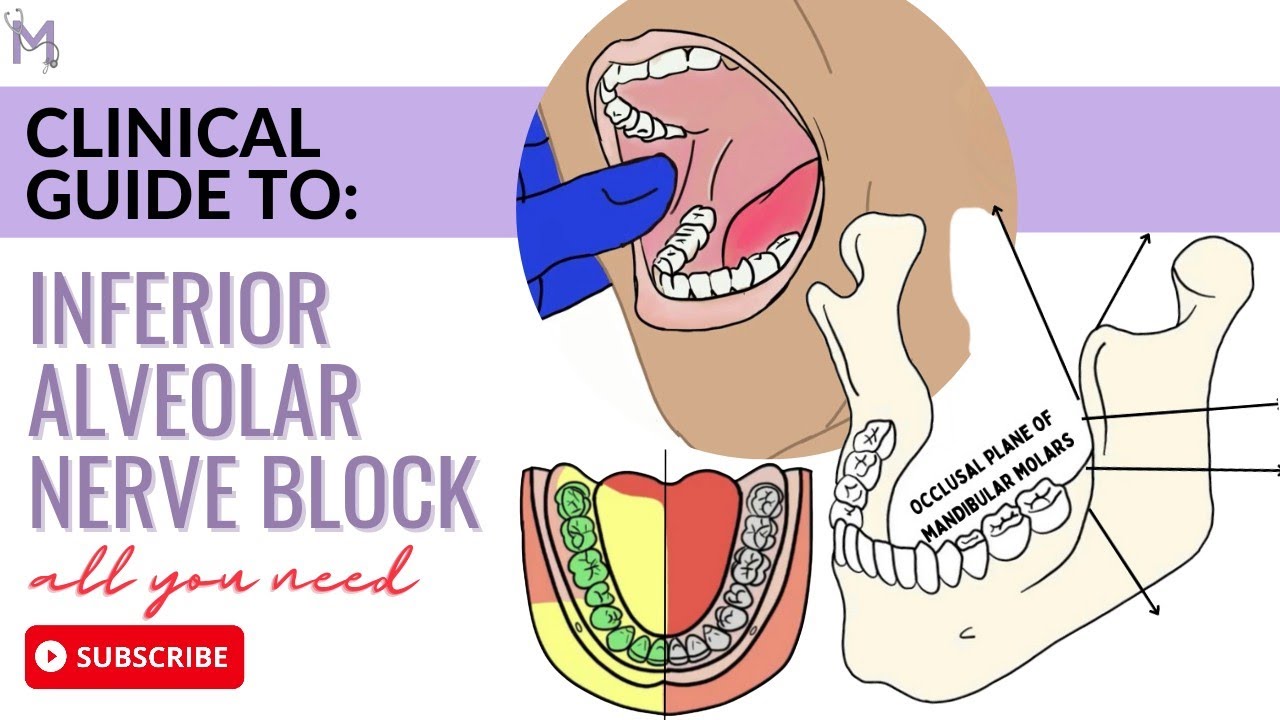 Inferior Alveolar Nerve Block Technique Video