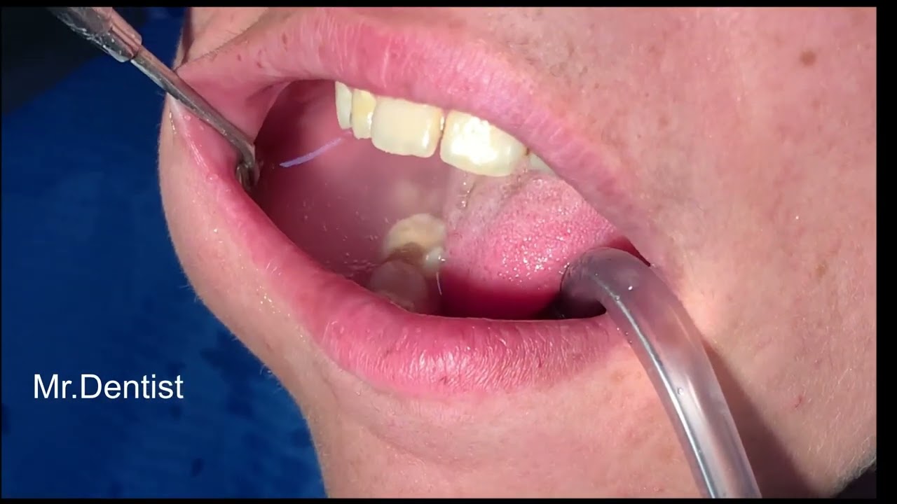 Complicated Extraction Of A Third Molar !!!! - YouTube