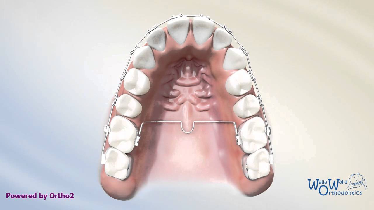 Trans-Palatal Arch - YouTube