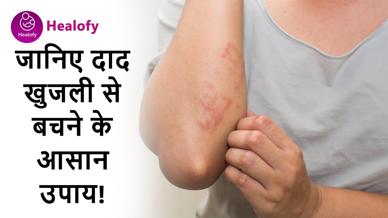 दाद-खाज-खुजली: कारण लक्षण इलाज उपाय | Ringworm-Daad-Khaj-Khujli Reason ...