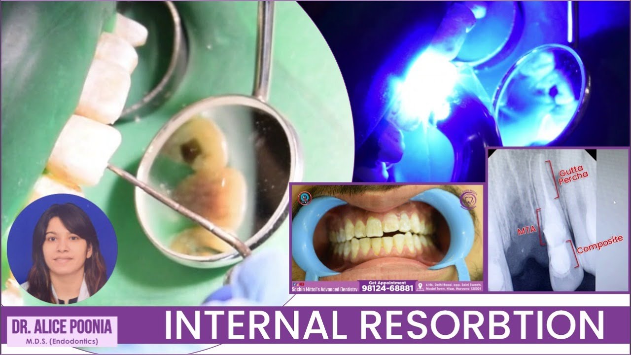 Tooth Internal Resorption : Process, Care, Cause, Remedies | Dr. Alice ...
