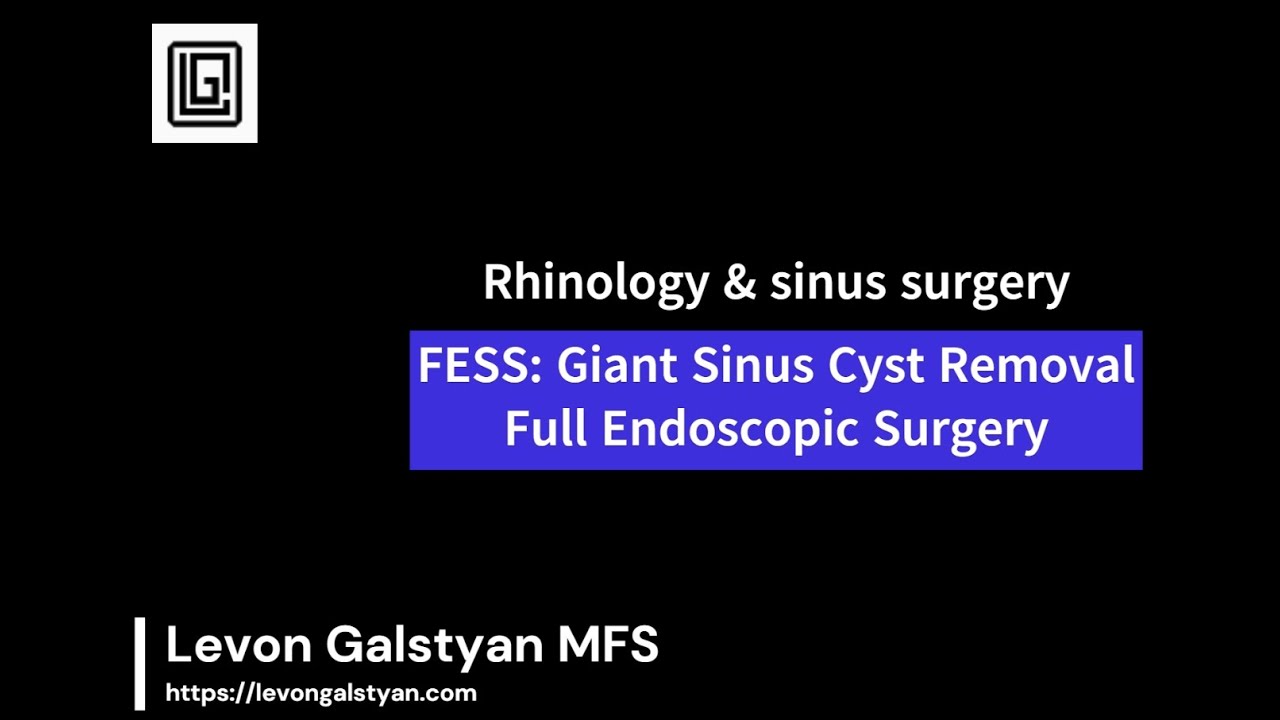 FESS: Giant Sinus Cyst Removal | Full Endoscopic Sinus Surgery Case Presentation - YouTube
