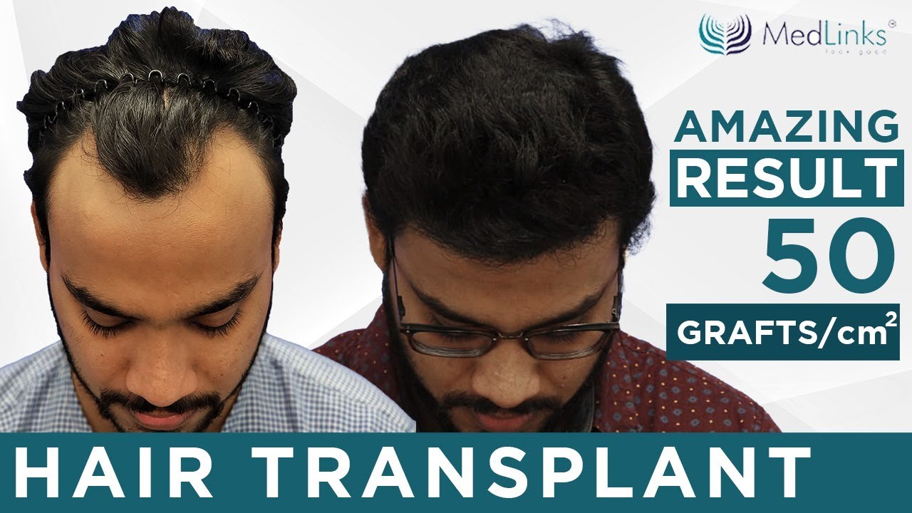 Hair Transplant Surgery | Results After 6 Months | Grade 2 Baldness ...