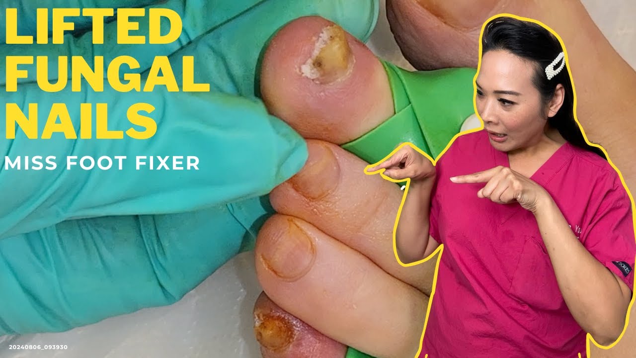 Lifted Fungal Nails: Get Ready to Look Fabulous! || Miss Foot Fixer ...