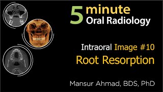Root Resorption: Intraoral Radiographic Interpretation | Doovi