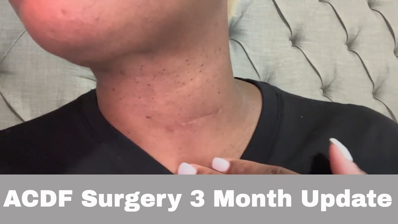 ACDF Surgery 3 Month Update | 4K - YouTube
