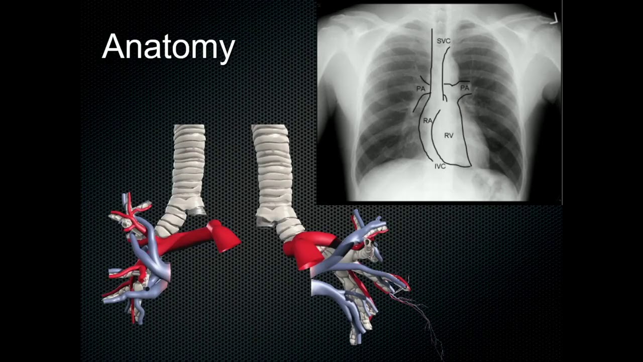 Mastering Medicine series: Chest X-rays - YouTube