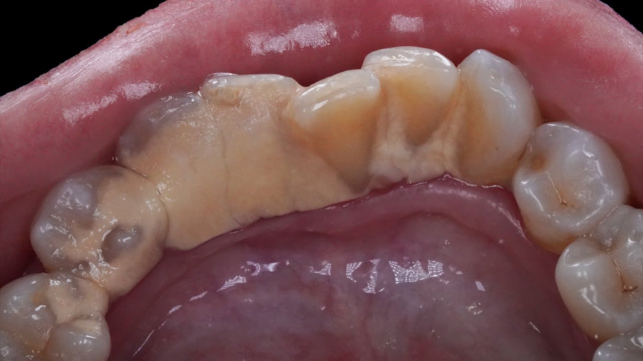 Yellow tartar has accumulated in this woman's mouth. - YouTube