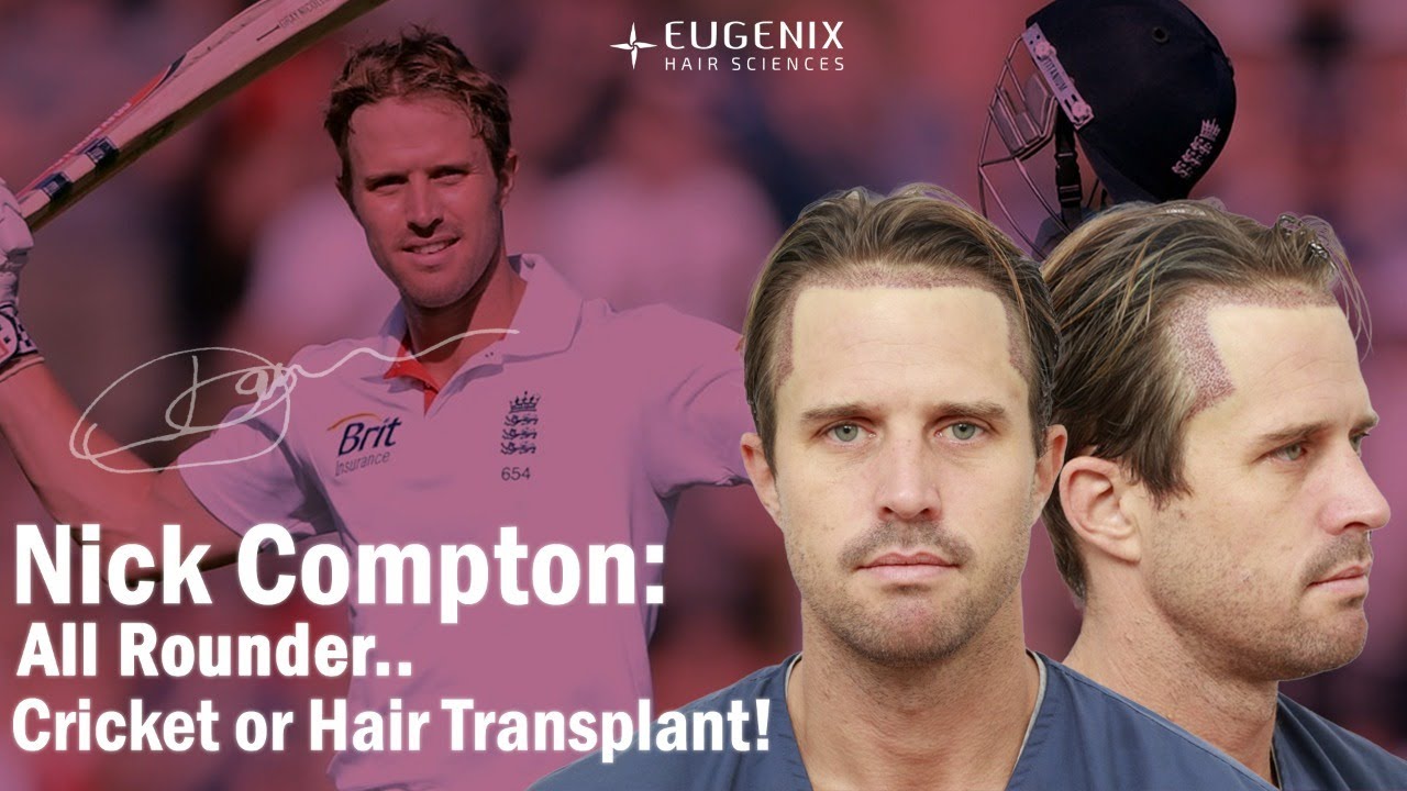 Phenomenal Non-Trim Hair Transplant of Former Cricketer Nick Compton ...