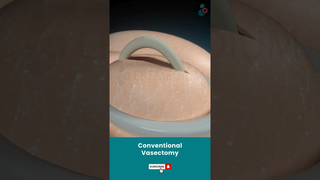 Conventional Vasectomy Surgery ↪ 3D Medical Animation #Shorts # ...