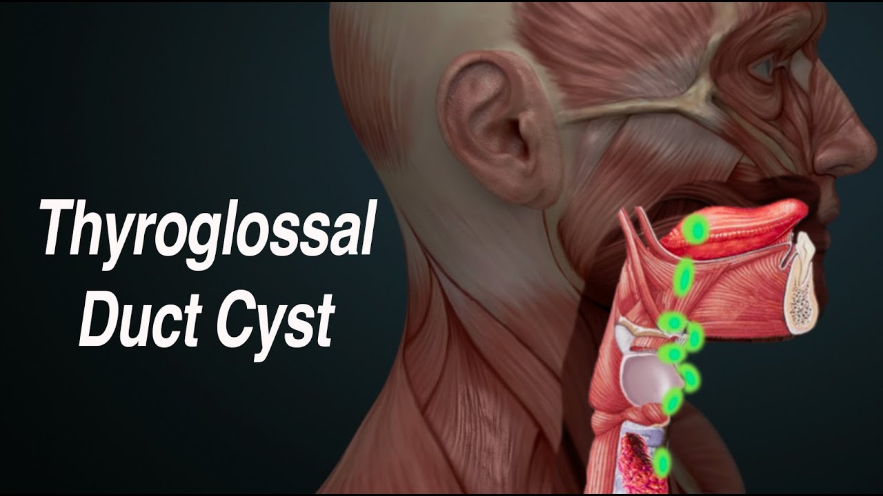 Thyroglossal Duct Cyst (Midline Neck Mass) - YouTube