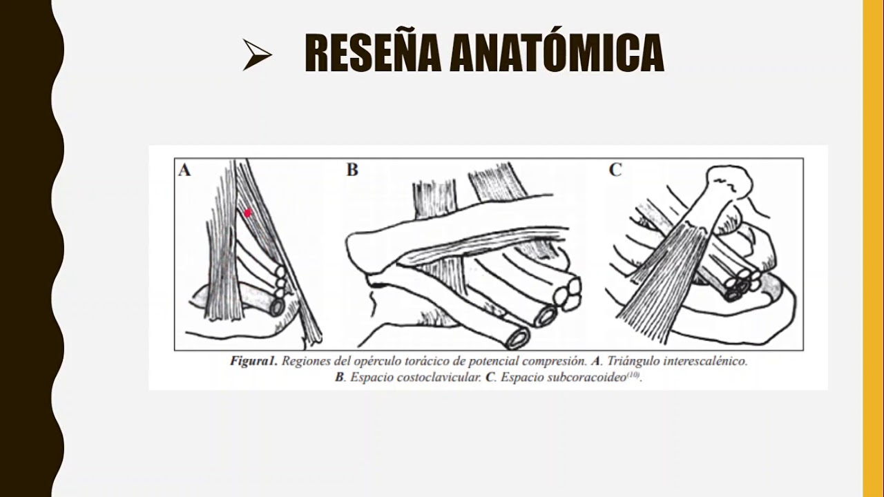 Síndrome de Vena Cava y Opérculo Torácico - YouTube