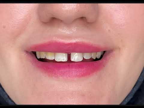 Diastema nedir, nasıl tedavi edilir