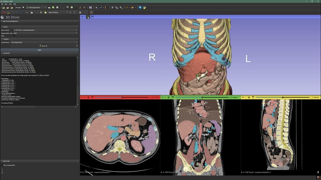 TotalSegmentator + 3D Slicer | From DICOM to Full 3D Before Your Coffee ...