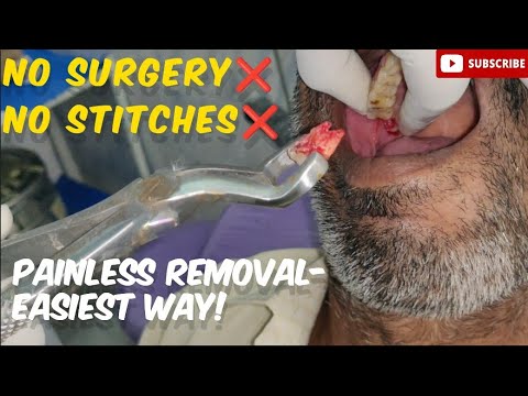 Infected Wisdom Teeth Removal- Step by Step procedure #wisdomteeth # ...