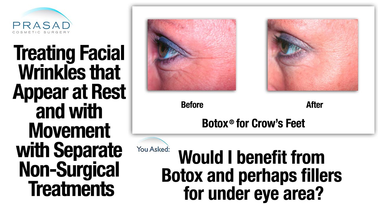 Treating Facial Wrinkles that Appear at Rest, and Those that Appear in ...