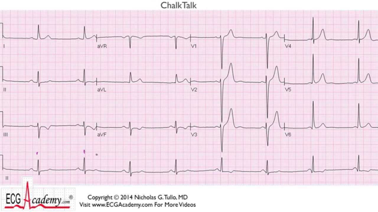 ECG Interpretation Tutorial - ChalkTalk 145 - Advanced Level - YouTube