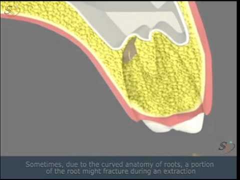 extraction of root tip - YouTube